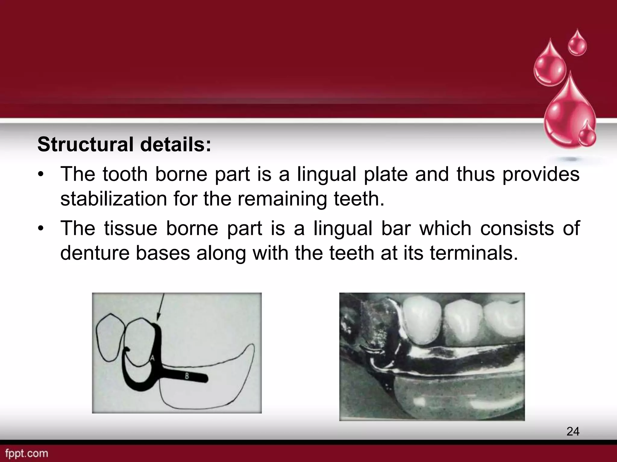 stress breakers in prosthodontics | PPTX