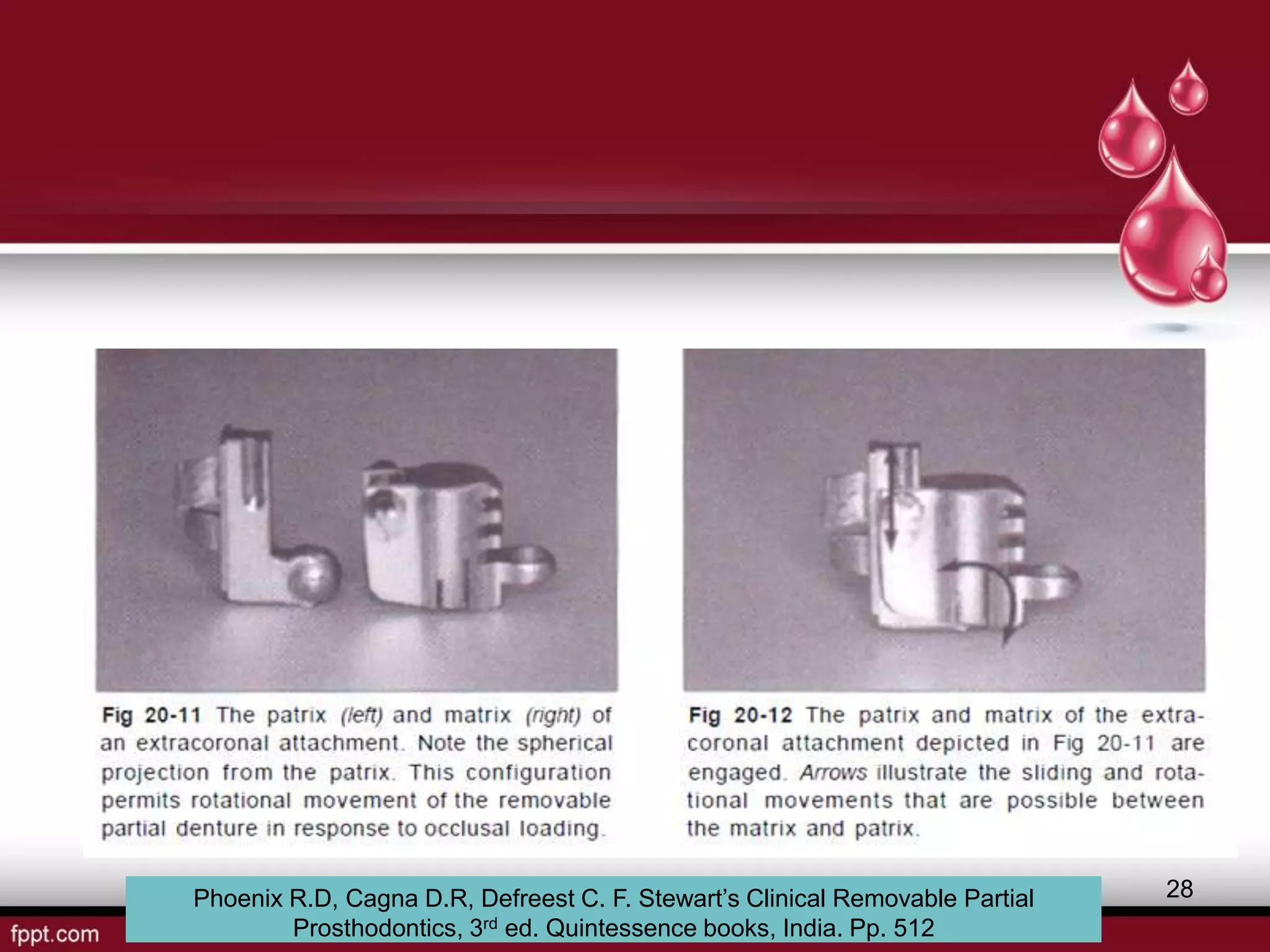 stress breakers in prosthodontics | PPTX