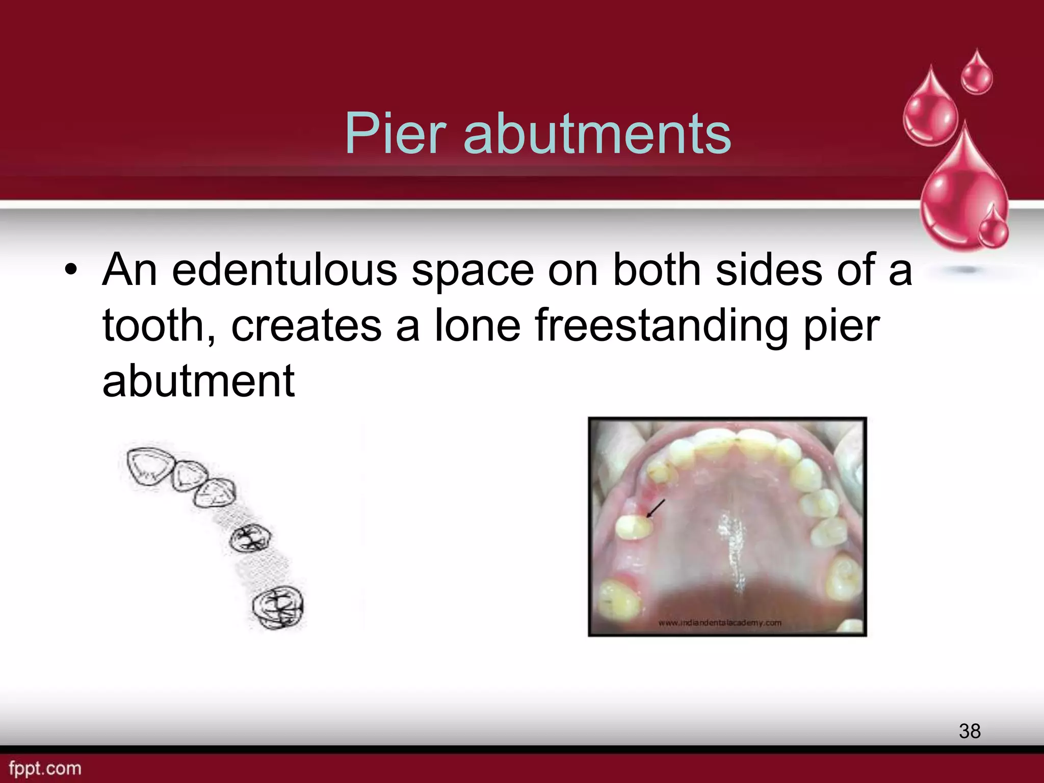 stress breakers in prosthodontics | PPTX