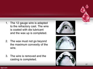 stress breakers in prosthodontics | PPTX
