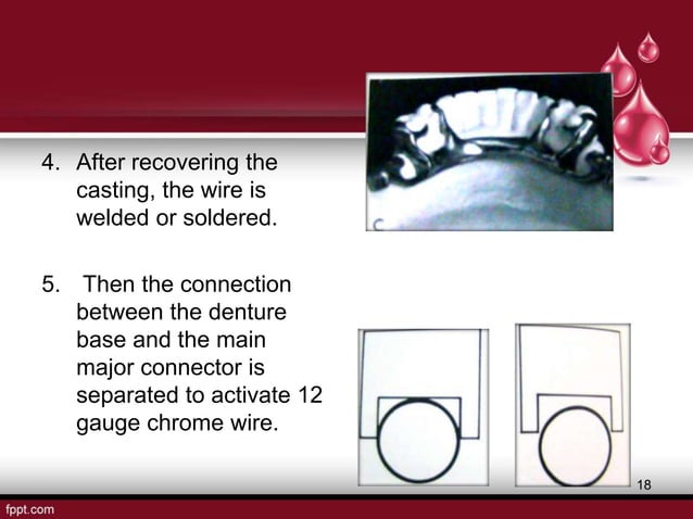 stress breakers in prosthodontics | PPTX | Dental Health | Diseases and ...