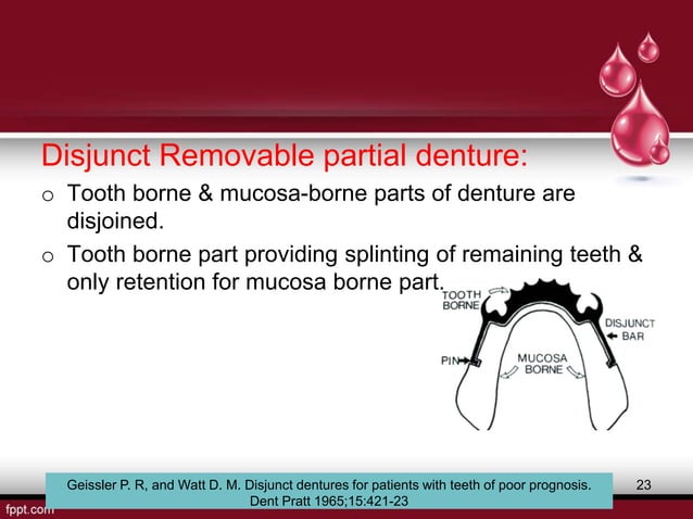 stress breakers in prosthodontics | PPTX | Dental Health | Diseases and ...