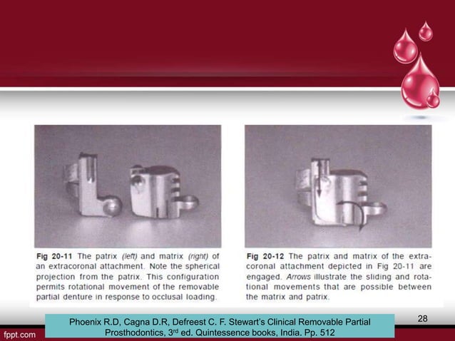stress breakers in prosthodontics | PPTX | Dental Health | Diseases and ...