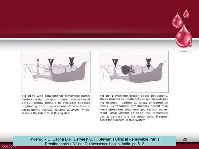 stress breakers in prosthodontics | PPTX | Dental Health | Diseases and ...