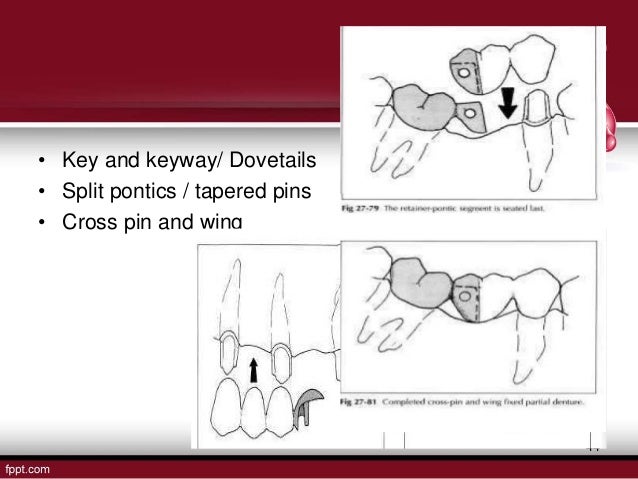 stress breakers in prosthodontics
