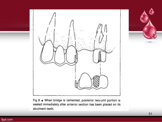 stress breakers in prosthodontics