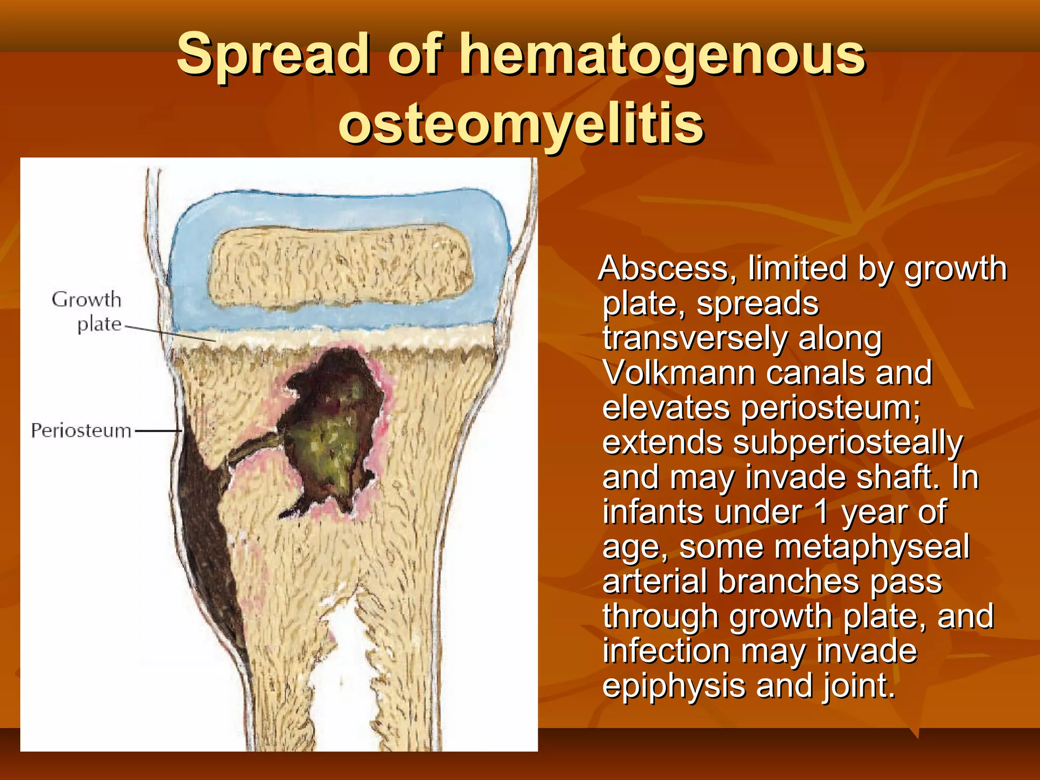 Inflammatory disease of bones | PPT