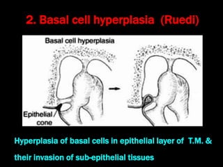 Chronic suppurative otitis media attico-antral disease (CSOM AA) | PPTX