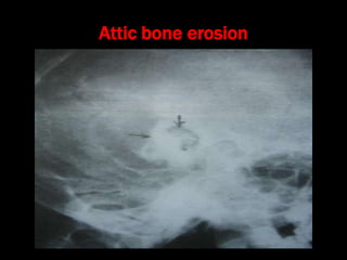 Chronic suppurative otitis media attico-antral disease (CSOM AA) | PPTX