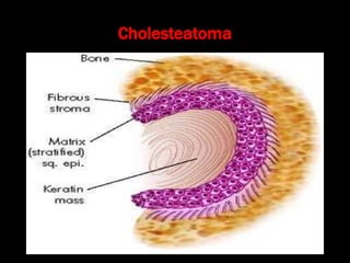 Chronic suppurative otitis media attico-antral disease (CSOM AA) | PPTX