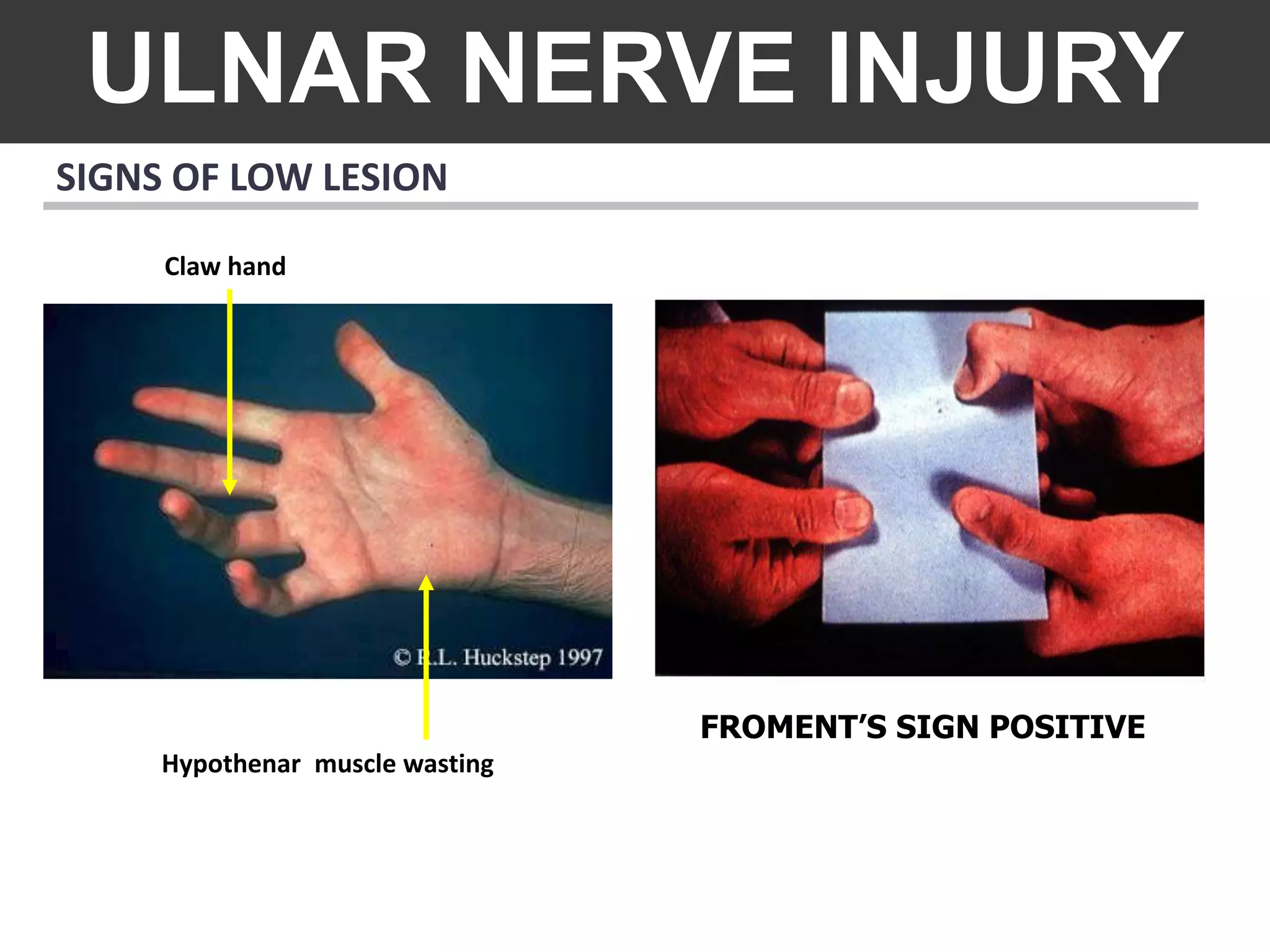 Peripheral Nerve Injuries | PPTX