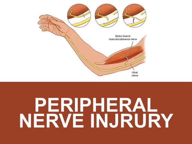 Peripheral Nerve Injuries | PPT
