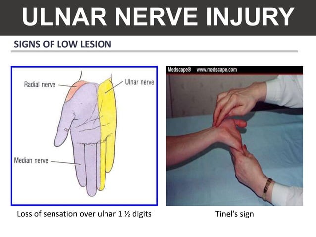 Peripheral Nerve Injuries | PPTX