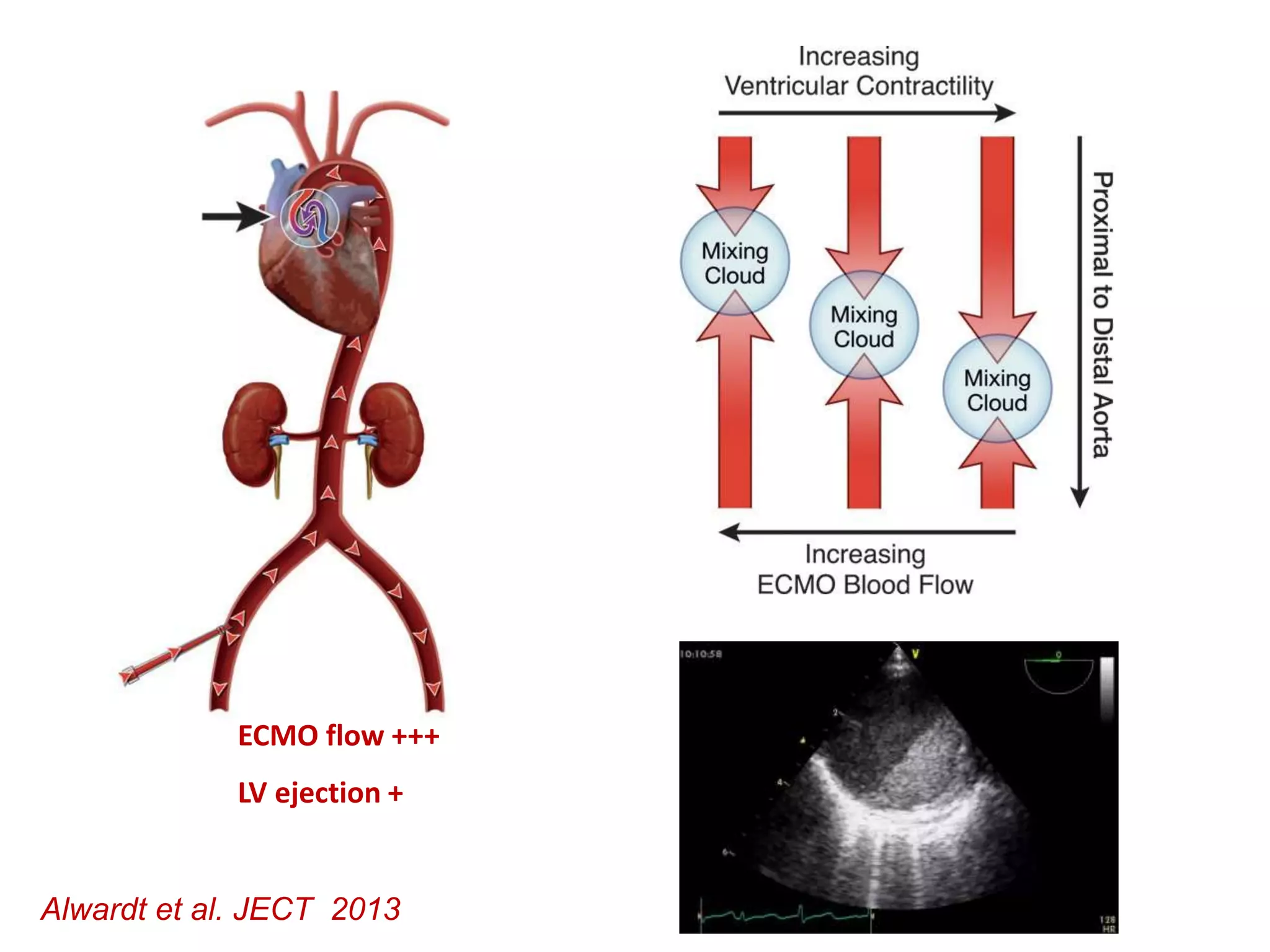15. hemodynamic monitoring during ecmo #beach2019 (bouchez) | PPTX ...