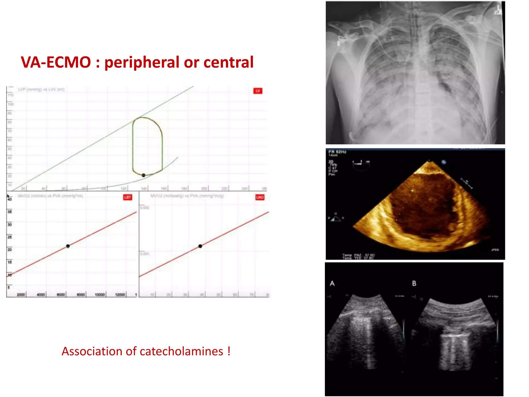 15. hemodynamic monitoring during ecmo #beach2019 (bouchez) | PPTX ...