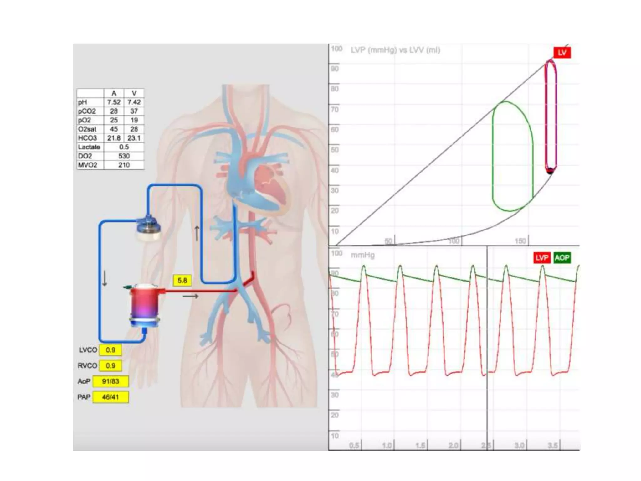 15. hemodynamic monitoring during ecmo #beach2019 (bouchez) | PPTX ...