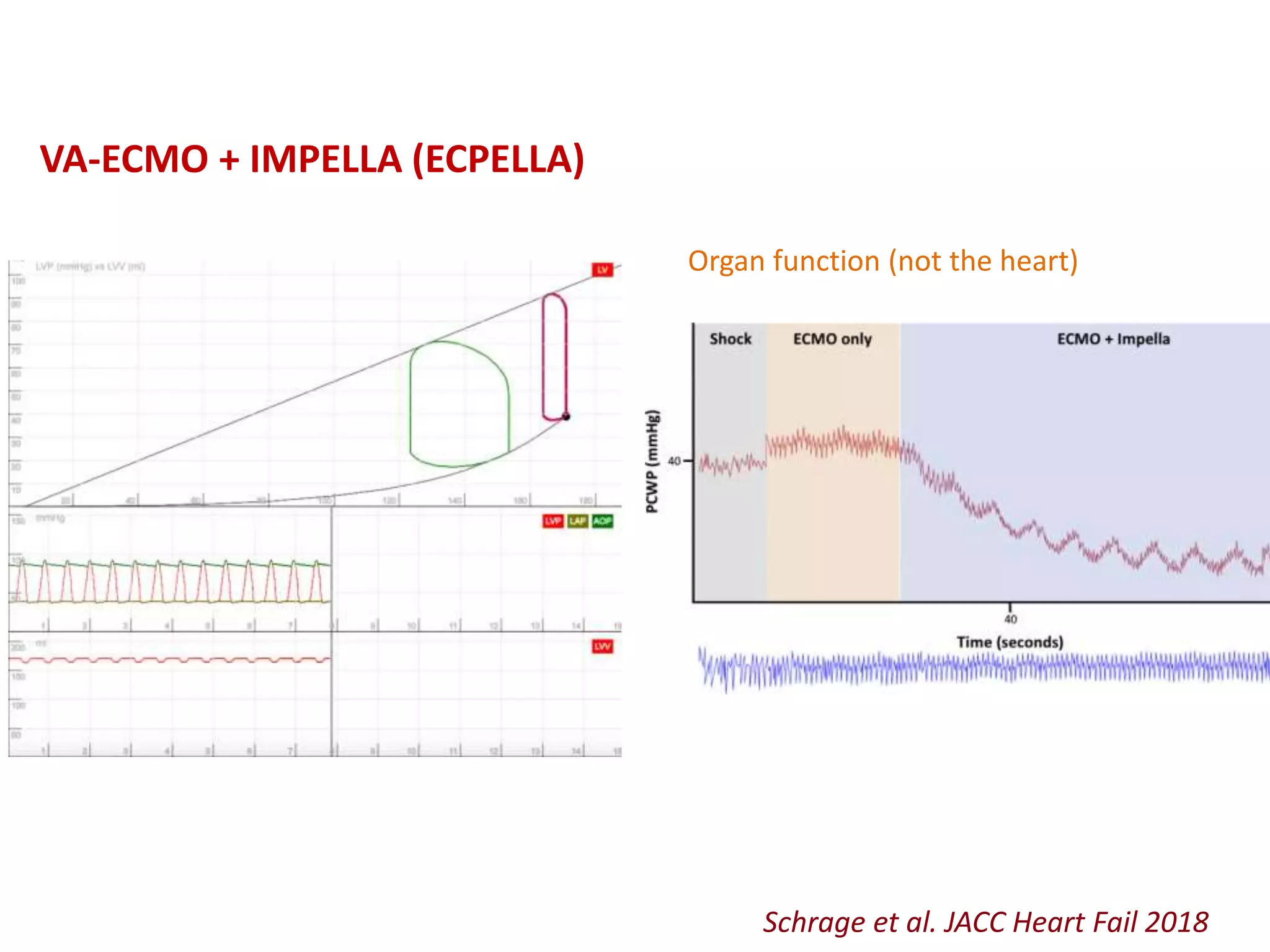 15. hemodynamic monitoring during ecmo #beach2019 (bouchez) | PPTX ...
