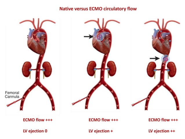 15. hemodynamic monitoring during ecmo #beach2019 (bouchez) | PPT