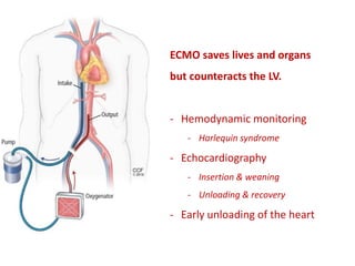 15. hemodynamic monitoring during ecmo #beach2019 (bouchez) | PPTX ...