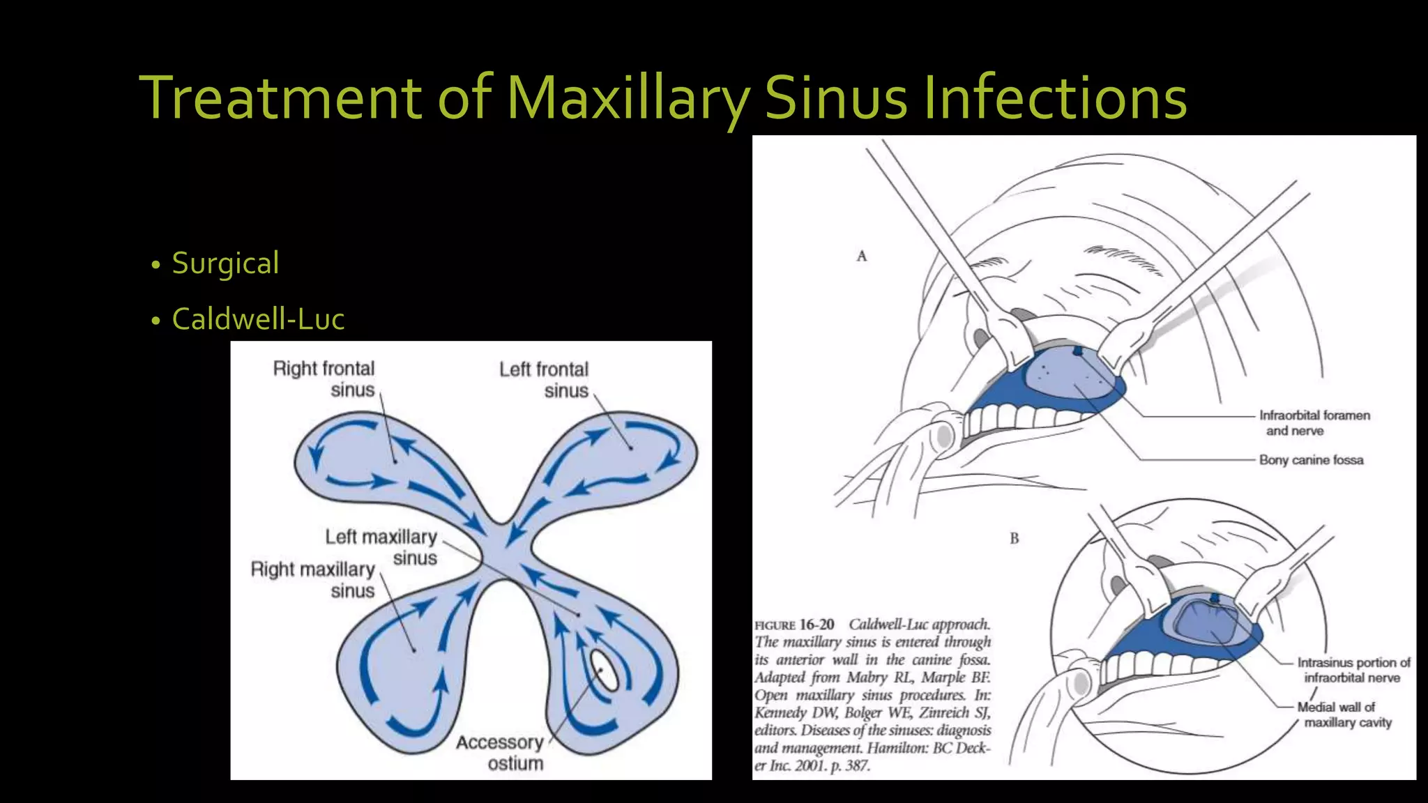 Odontogenic Diseases of the Maxillary Sinus | PPTX