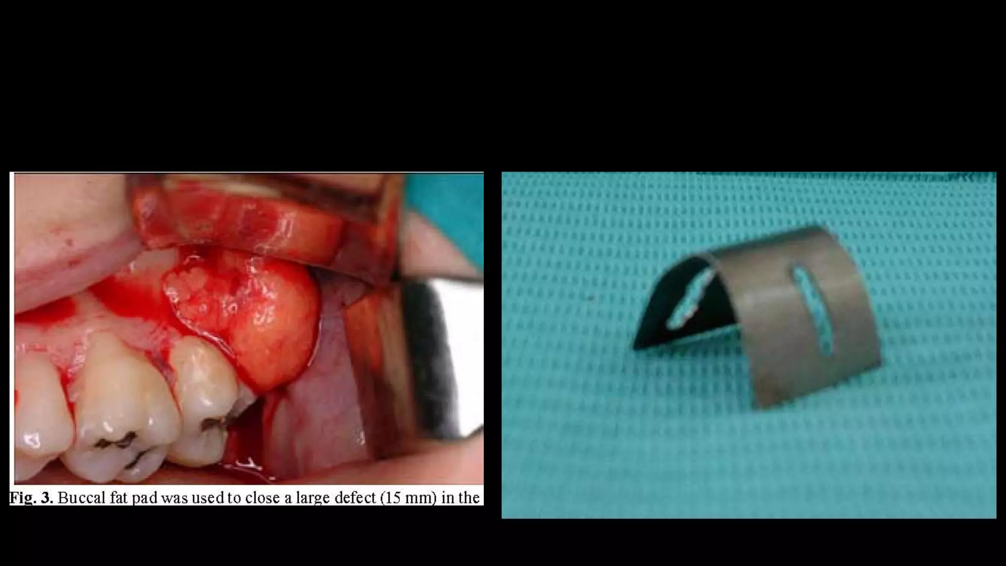 Odontogenic Diseases Of The Maxillary Sinus Ppt