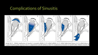 Odontogenic Diseases of the Maxillary Sinus | PPTX
