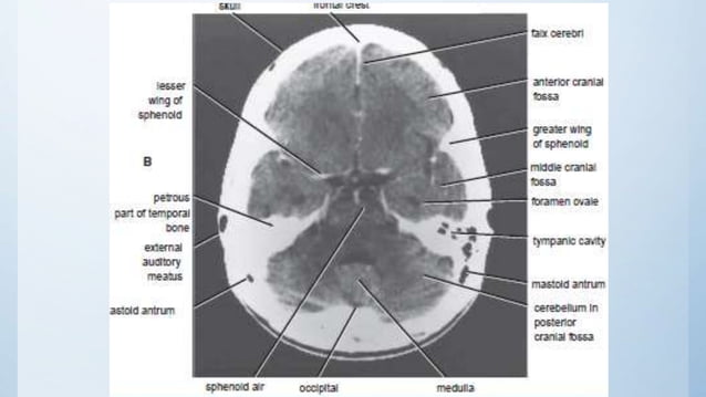 Radiographic Anatomy of the Head and Neck | PPTX