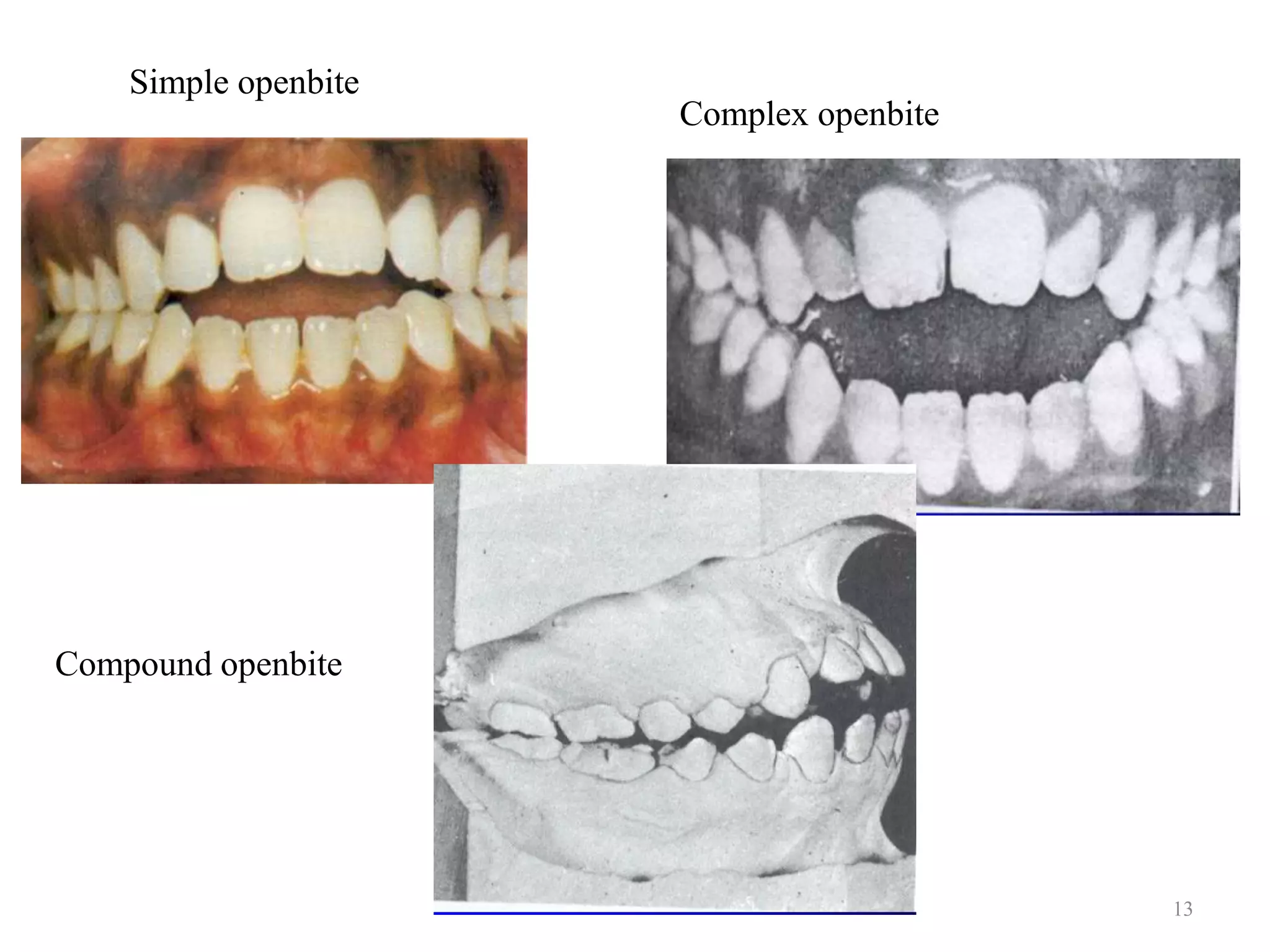 MANAGEMENT OF OPEN BITE | PPT