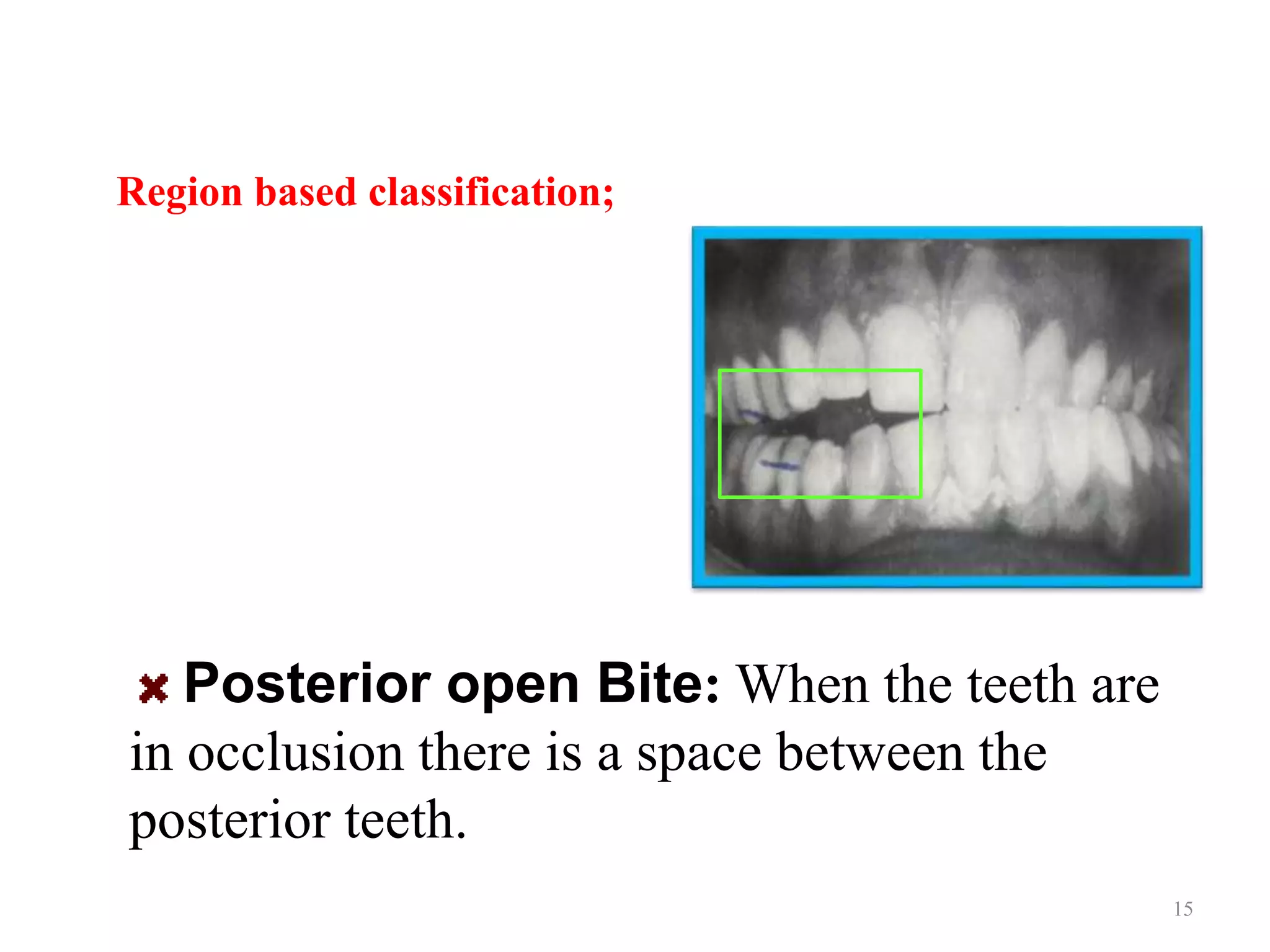 MANAGEMENT OF OPEN BITE | PPT