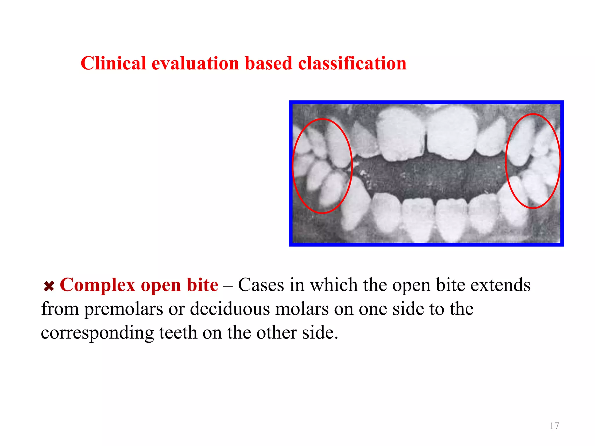MANAGEMENT OF OPEN BITE | PPT