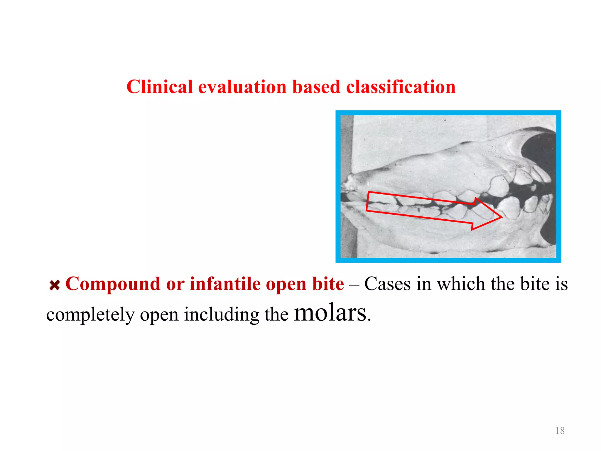 MANAGEMENT OF OPEN BITE | PPT