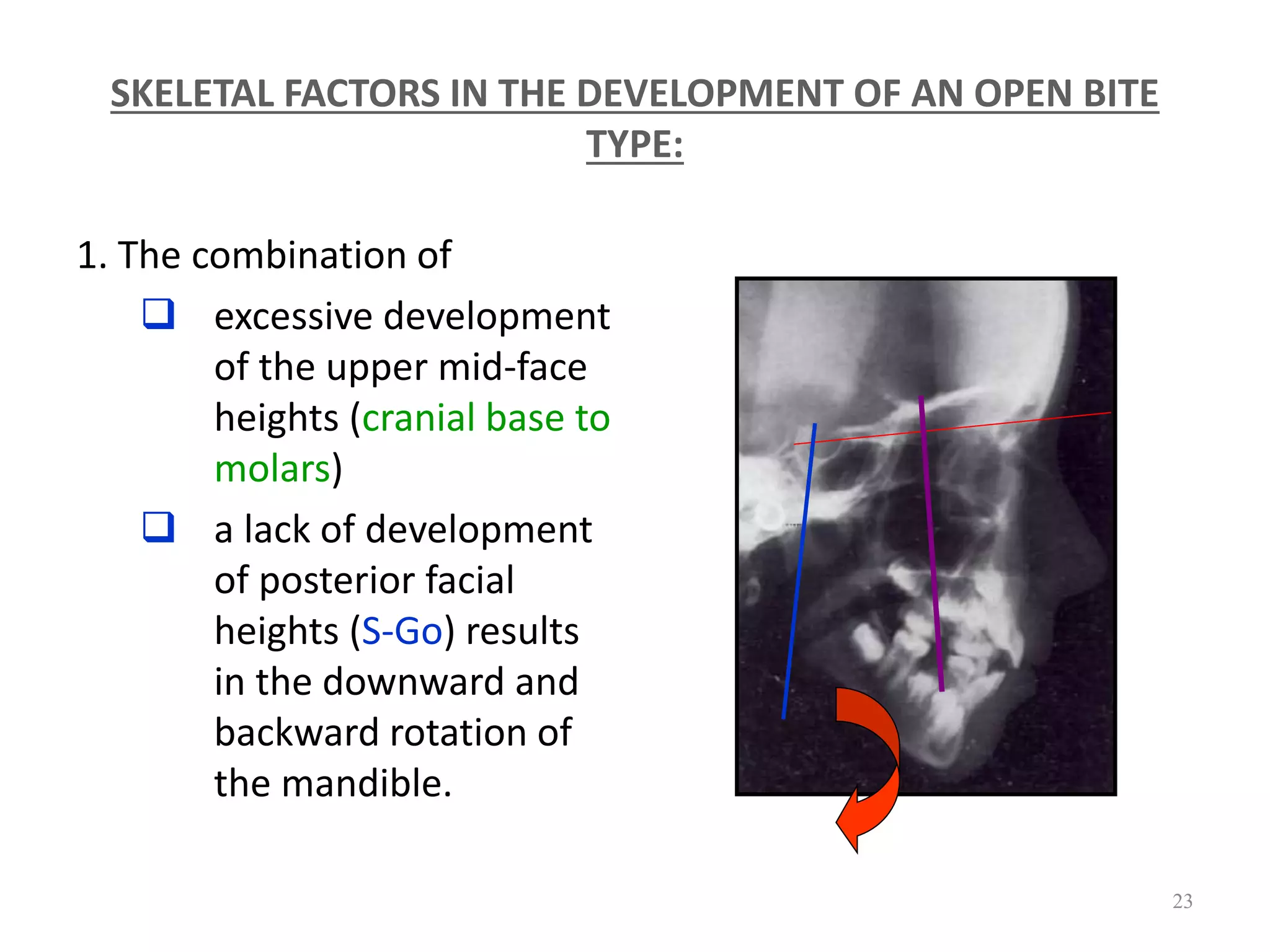 MANAGEMENT OF OPEN BITE | PPT