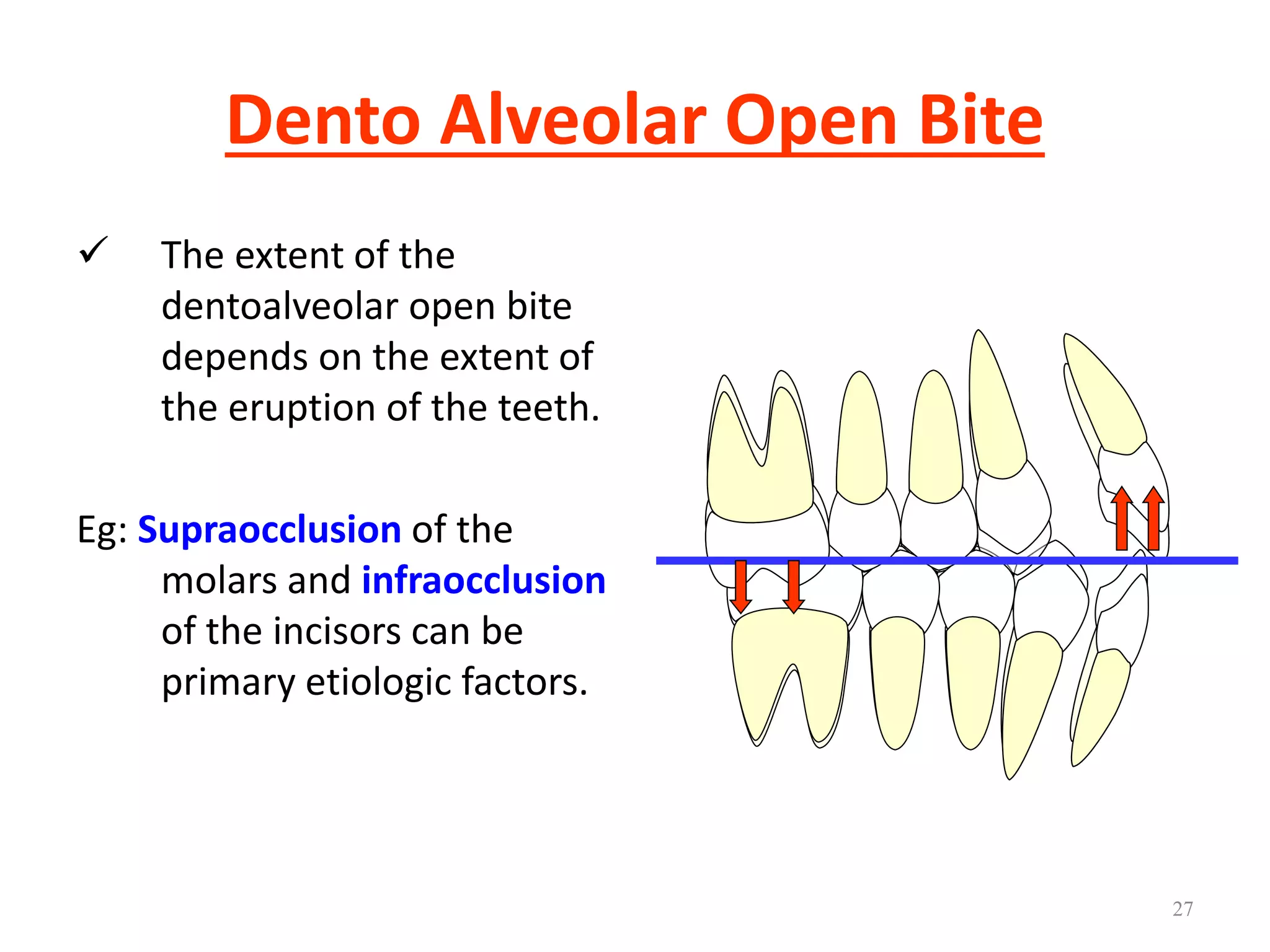 MANAGEMENT OF OPEN BITE | PPT
