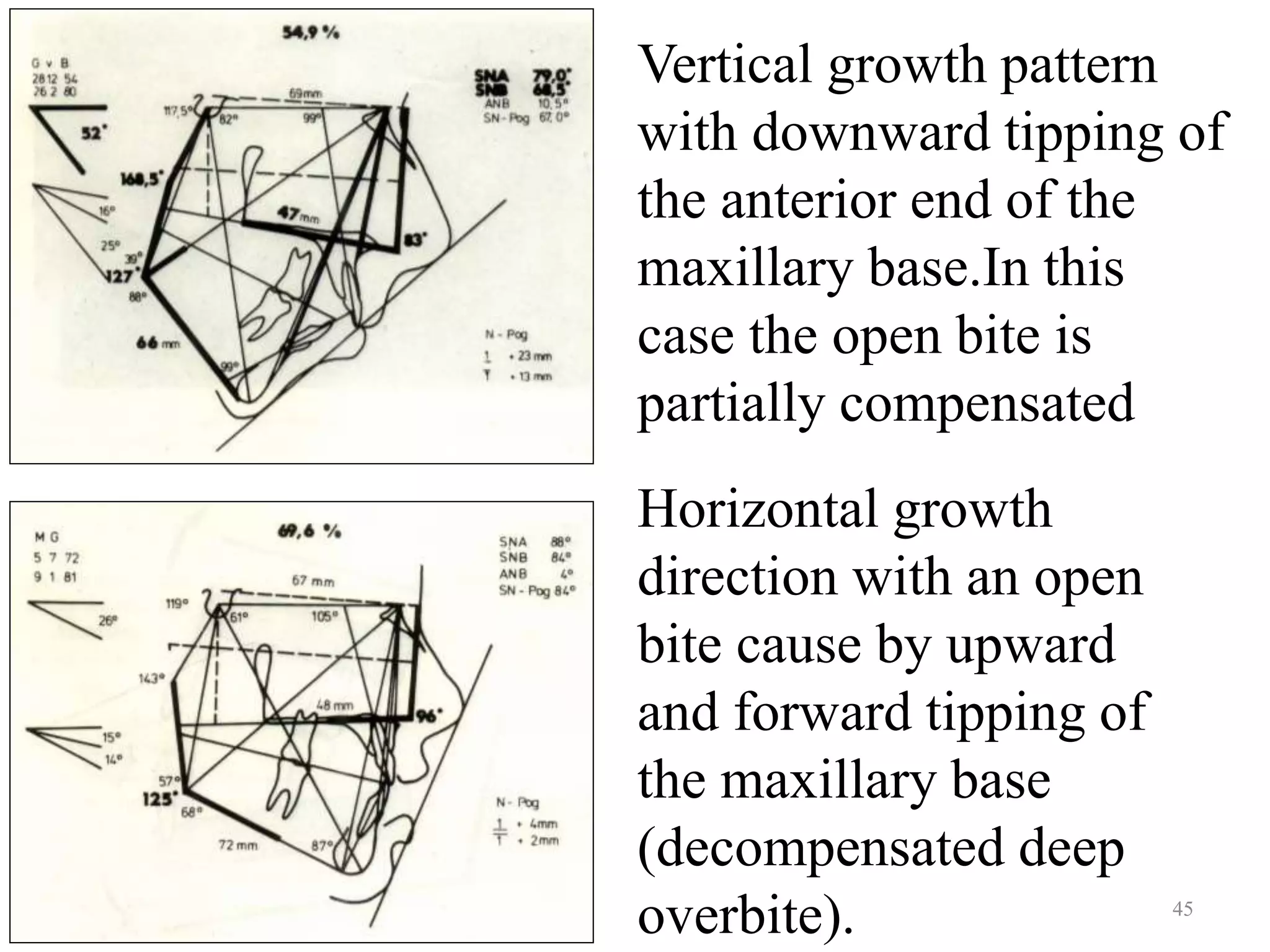 MANAGEMENT OF OPEN BITE | PPT