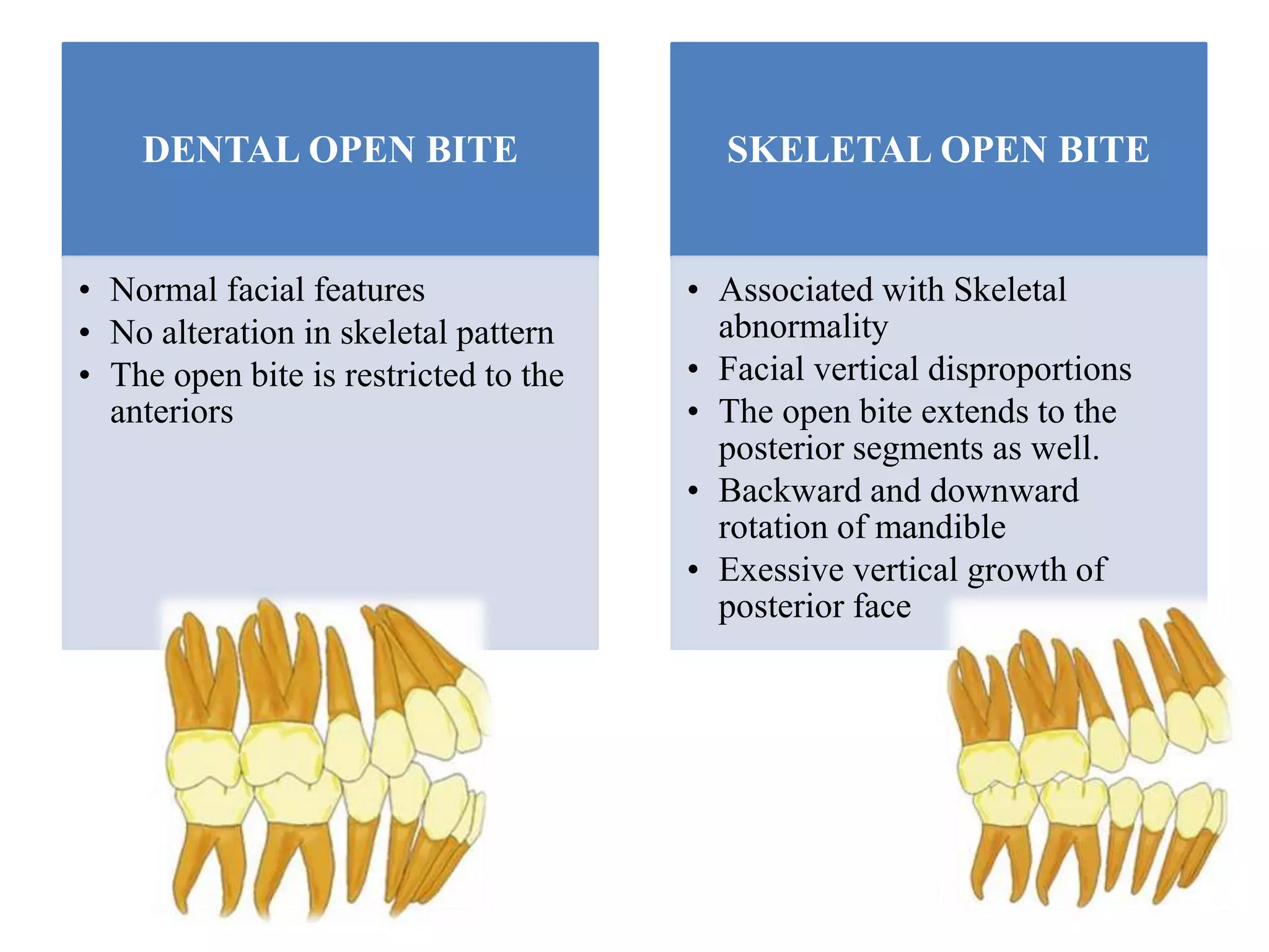 MANAGEMENT OF OPEN BITE | PPT