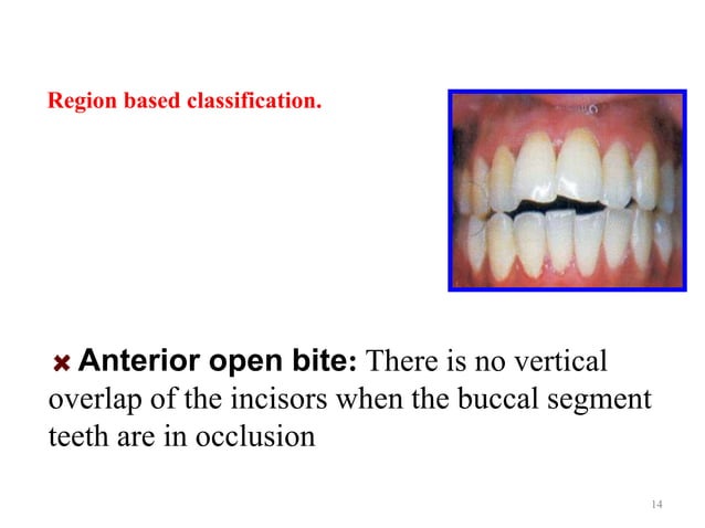 MANAGEMENT OF OPEN BITE | PPT