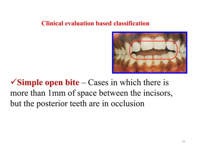 MANAGEMENT OF OPEN BITE | PPT