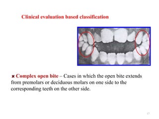 MANAGEMENT OF OPEN BITE | PPT