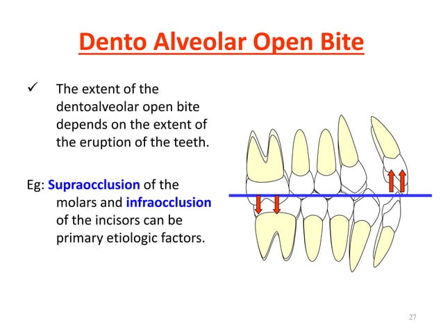 MANAGEMENT OF OPEN BITE | PPT