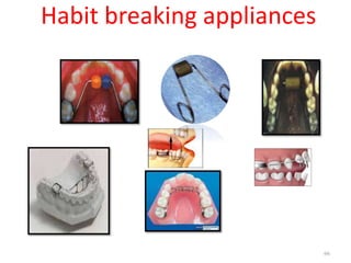 MANAGEMENT OF OPEN BITE | PPT