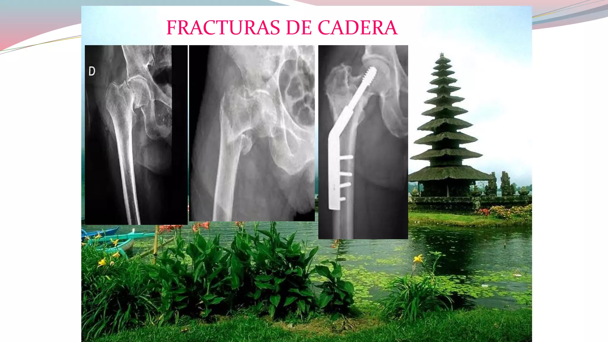 15. Fracturas de cadera F.pptx