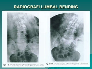 15.LUMBAL BENDING.pptx