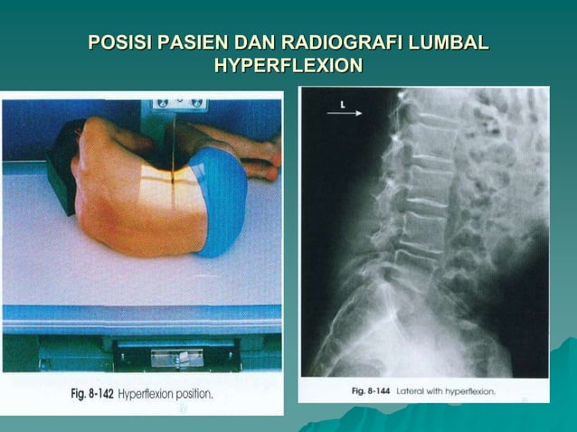 15.LUMBAL BENDING.pptx
