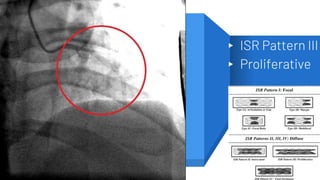 Stent thrombosis & Restenosis.pptx