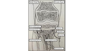 15.Bone and Joint Infections. Types, clinical presentation and investigation | PDF | Bone and ...