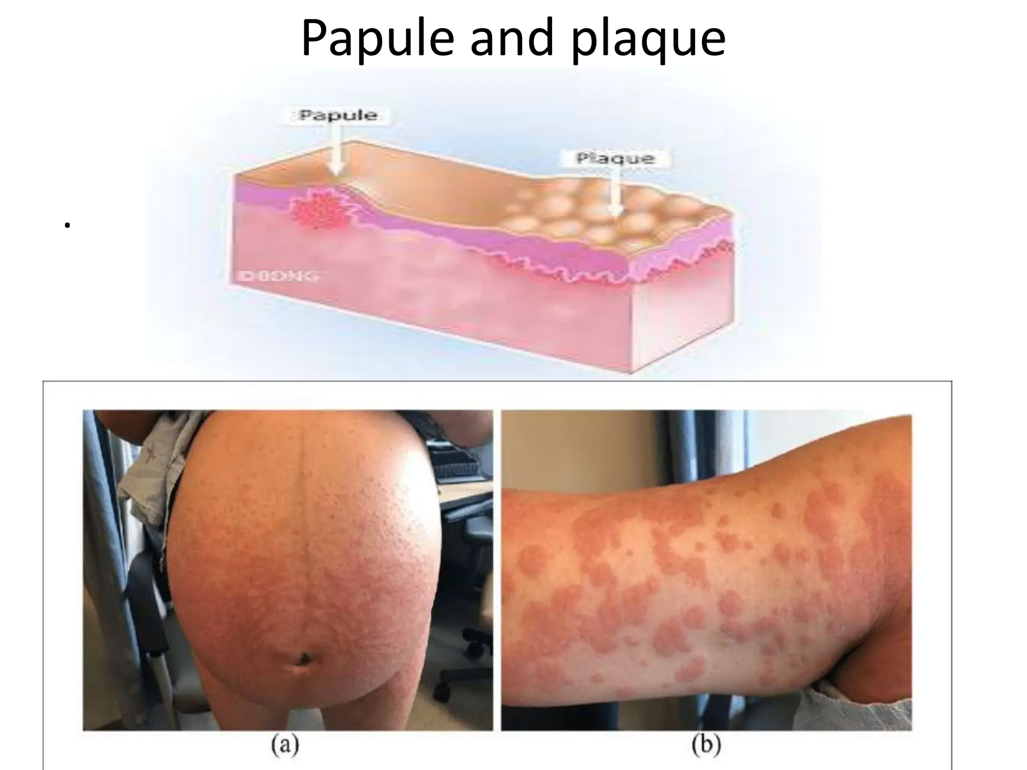 15. PAEDIATRIC DERMATOLOGICAL CONDITIONS(Psoriasis, pytriasis alba ...