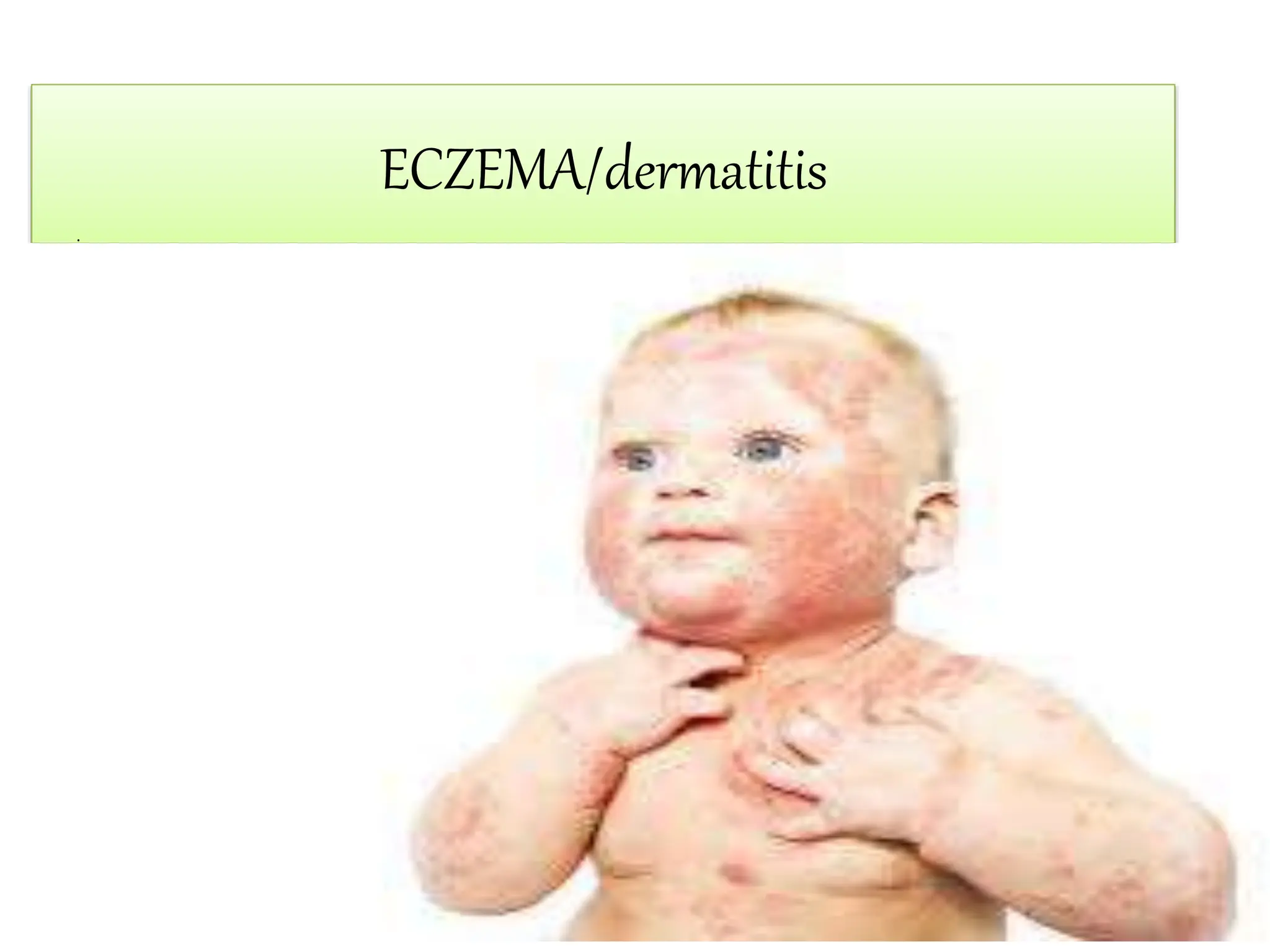 15. PAEDIATRIC DERMATOLOGICAL CONDITIONS(Psoriasis, pytriasis alba ...