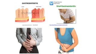Gastroenteritis Viruses: Causes, Transmission, Symptoms, and Prevention ...