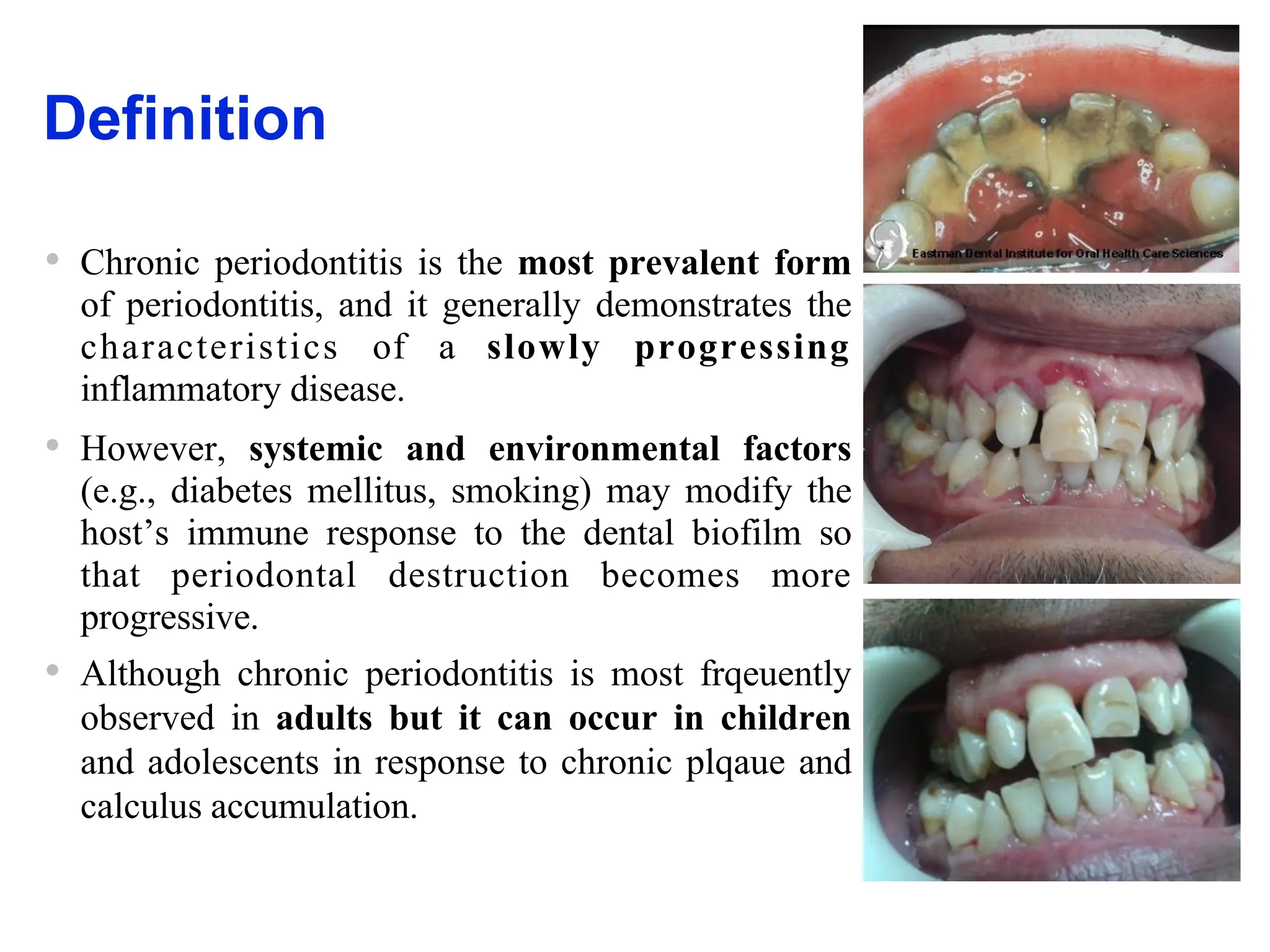 Chronic periodontitis is a persistent gum infection that leads to ...