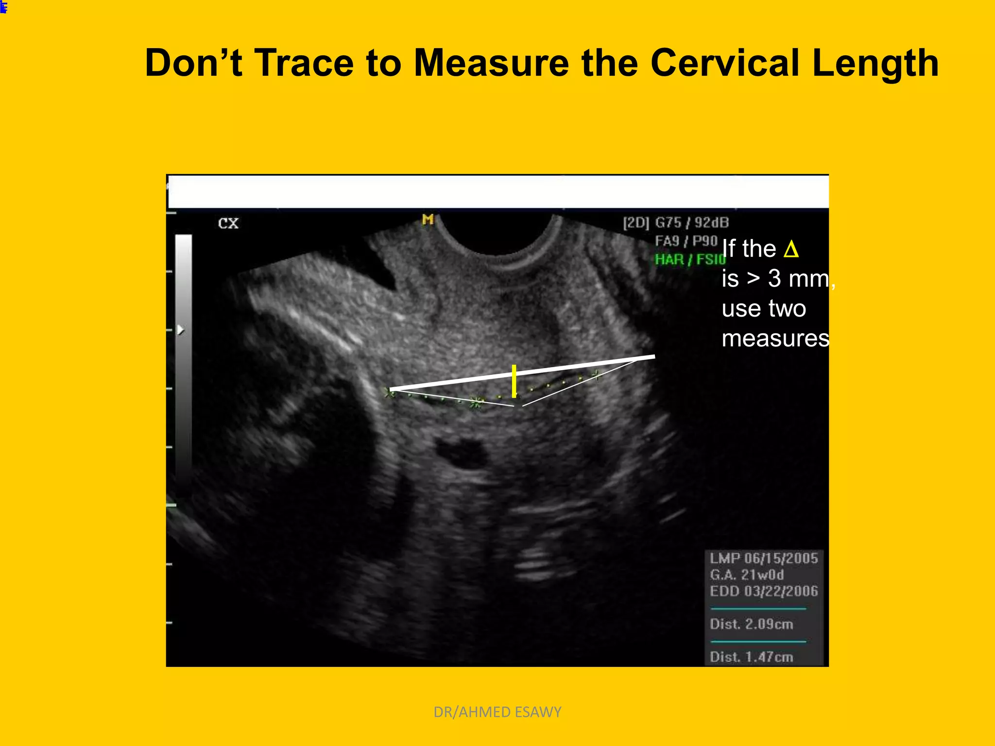 15-cervical insufficiency imaging Dr Ahmed Esawy | PPT